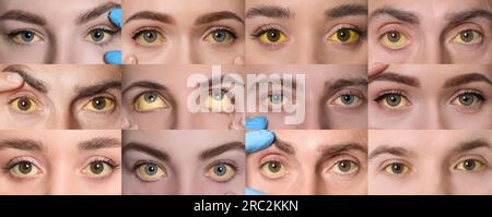 Yellowing of eyes as symptom of hepatitis. Collage with photos of ...