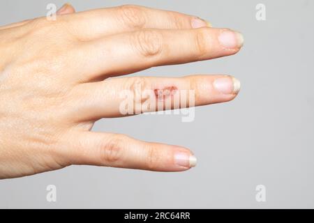 female hand with a scab due to impetigo, a contagious bacterial ...