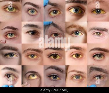 Yellowing of eyes as symptom of hepatitis. Collage with photos of ...