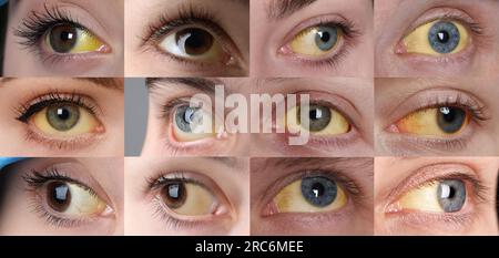 Yellowing of eyes as symptom of hepatitis. Collage with photos of ...