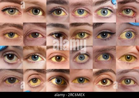 Yellowing of eyes as symptom of hepatitis. Collage with photos of ...