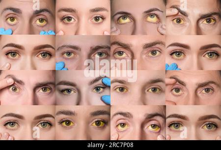 Yellowing of eyes as symptom of hepatitis. Collage with photos of ...