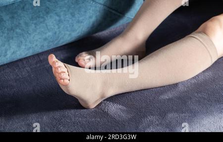 Chronic venous (vein) insufficiency in the leg of an adult woman ...