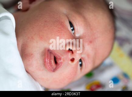 rash baby allergy on face / disease baby girl face dry skin itching and ...