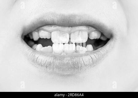 Close up of unhealthy baby teeths. Kid patient open mouth showing ...