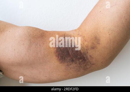 injury ligament arm bruise Stock Photo - Alamy