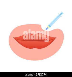 Lip augmentation, illustration Stock Photo - Alamy