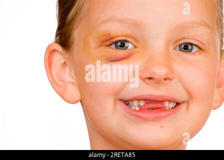 Girl with injury, black eye, missing teeth, hematoma, bruise, teeth ...