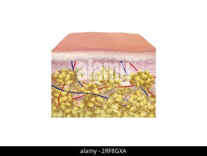 Section of skin with cellulite (compared to smooth skin) with epidermis ...