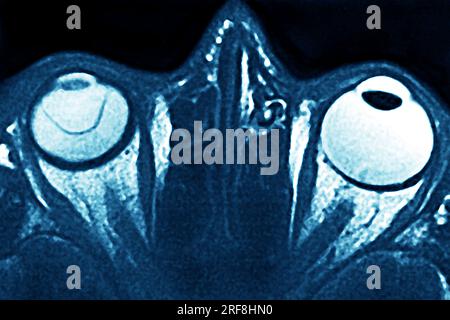 Retinal detachment of the left eye, visualized by radial section MRI ...