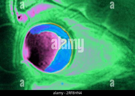 Retinal detachment of the left eye, visualized by radial section MRI ...