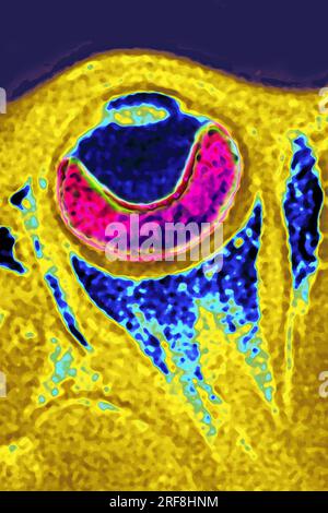 Retinal detachment of the left eye, visualized by radial section MRI ...
