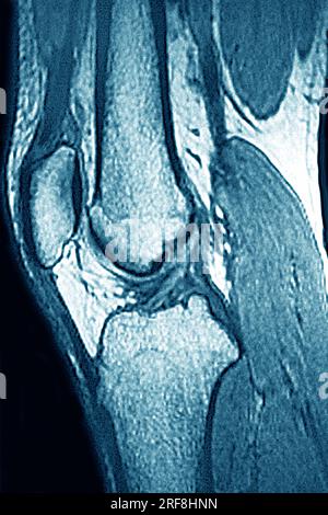 Normal knee visualized by MRI in sagittal section Stock Photo - Alamy