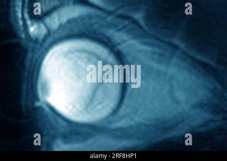 Retinal detachment of the left eye, visualized by radial section MRI ...