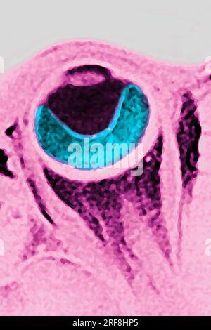 Retinal detachment of the left eye, visualized by radial section MRI ...