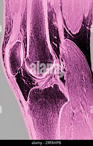 Normal knee visualized by MRI in sagittal section Stock Photo - Alamy