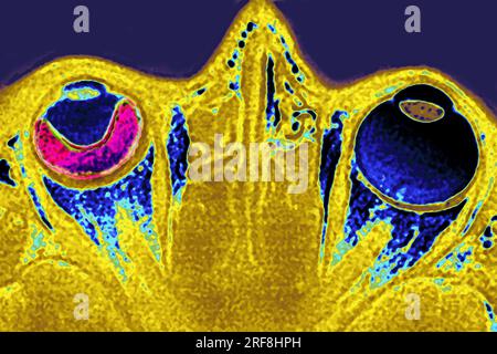 Retinal detachment of the left eye, visualized by radial section MRI ...