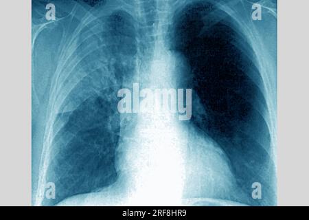 Pneumonia in a right lung (acute respiratory infection), revealed by ...