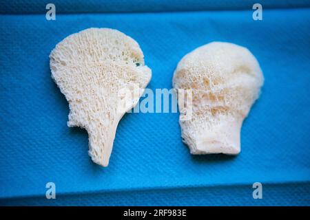 Viro-inactivated bone graft prepared in a tissue and cell biobank Stock ...