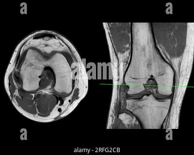 MRI Scan of both leg coronal view Stock Photo - Alamy
