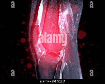 Magnetic resonance imaging or MRI of knee joint c for detect tear or ...