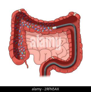 Illustration of Fecal Microbiota Transplantation (FMT Stock Photo - Alamy
