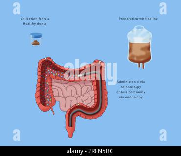 An illustration of the components of fecal microbiota transplantation ...