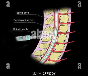 A lumbar puncture (spinal tap) is a test used to diagnose certain ...