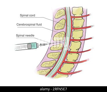 A lumbar puncture (spinal tap) is a test used to diagnose certain ...