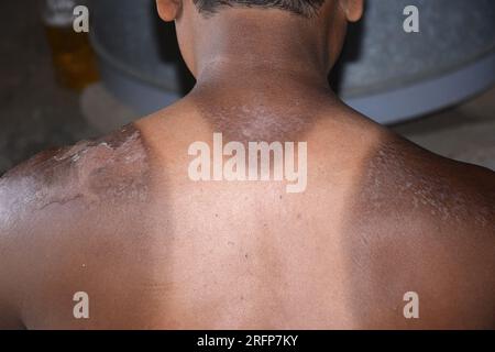 Sunburned man. Sunburned heavily, dusky skin versus very dark red and ...