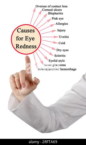 13 Causes for Eye Redness Stock Photo - Alamy