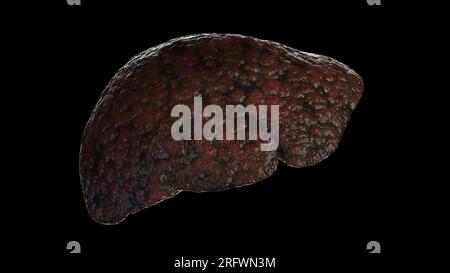 Cirrhotic liver, illustration Stock Photo - Alamy
