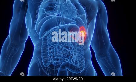 Splenic cancer, illustration Stock Photo - Alamy