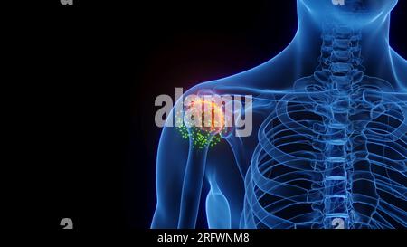 Inflamed shoulder joint healing, illustration Stock Photo - Alamy