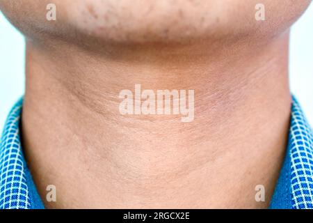 Aging skin folds or skin creases or wrinkles and neck fat pocket of ...