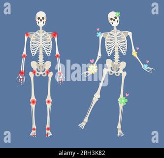 Human skeleton with pain points in rheumatoid arthritis. Men anatomy ...