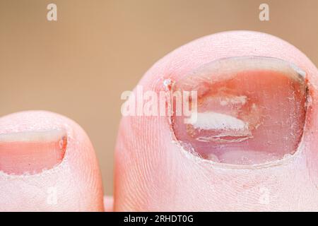 Damaged toenail plate close-up. Nail and skin diseases fungus Stock ...