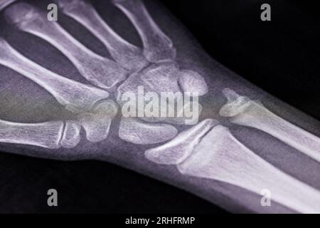x-ray of the hands, detail of the phalanges and joints,trapeze,scaphoid ...