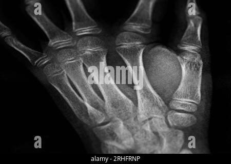 x-ray of the hands, detail of the phalanges and joints,trapeze,scaphoid ...