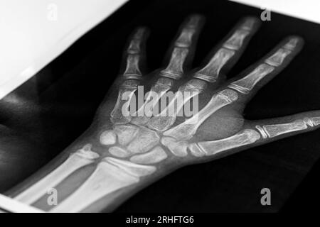 x-ray of the hands, detail of the phalanges and joints,trapeze,scaphoid ...