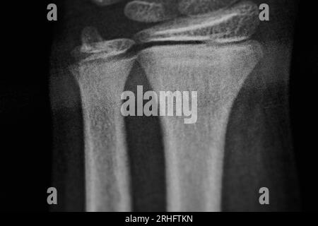 x-ray of the hands, detail of the phalanges and joints,trapeze,scaphoid ...