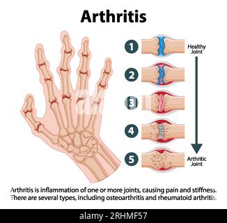 Illustrated infographic depicting stages of arthritis in the human hand Stock Vector Image & Art ...