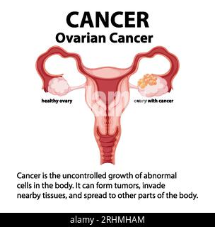 Illustrated infographic highlighting differences between healthy and cancerous prostate Stock ...