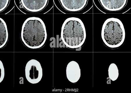 Multi slice CT scan of the brain showing Large brain stem and right ...