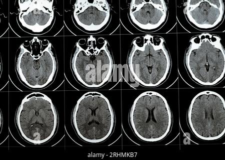 Multi slice CT scan of the brain showing Large brain stem and right ...