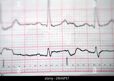 An ElectroCardioGraph ECG, a chart that draws the electricity of the ...