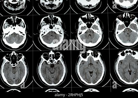 Multi slice CT scan of the brain showing Large brain stem and right ...
