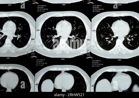 Multi slice CT scan of the chest showing normal study, normal ...