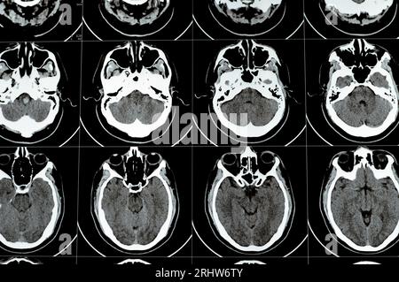 Multi slice CT scan of the brain showing Large brain stem and right ...