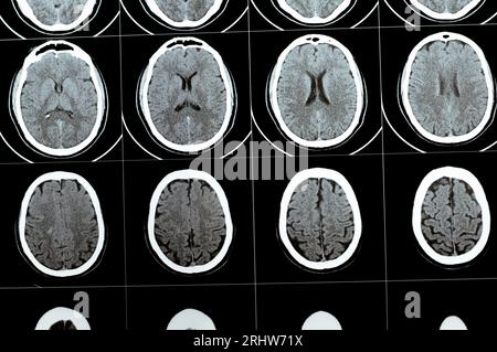Multi slice CT scan of the brain showing Large brain stem and right ...